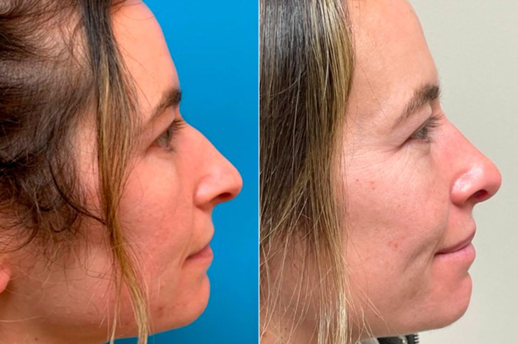 What Fixing a Droopy Nose Entails | Threads - WeRIndia